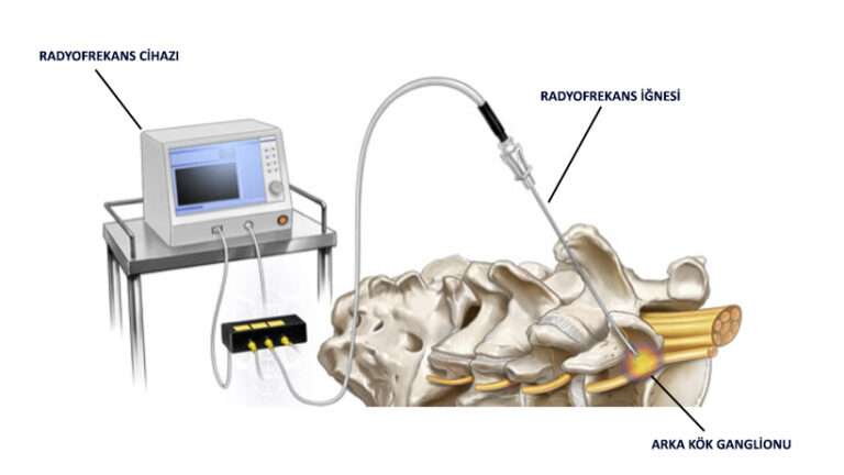 Pulsed Radyofrekans Yöntemiyle Bel ve Boyun Fıtığı Tedavisi