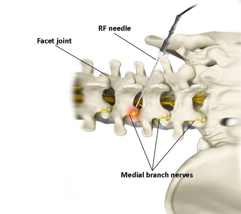 Medial Branch Nerve RF Ablation: Solving Back and Neck Pain