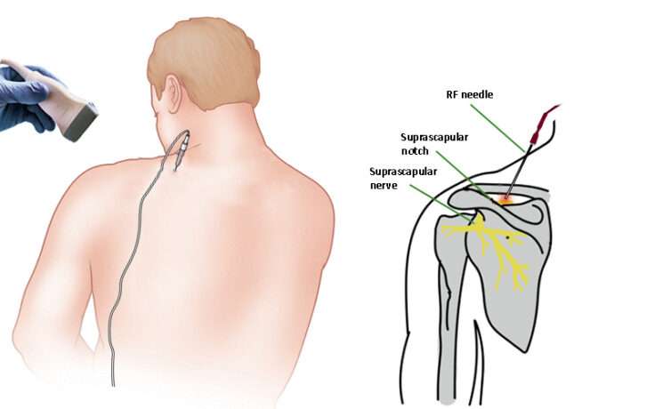 Suprascapular Nerve RF Ablation for Chronic Shoulder Pain